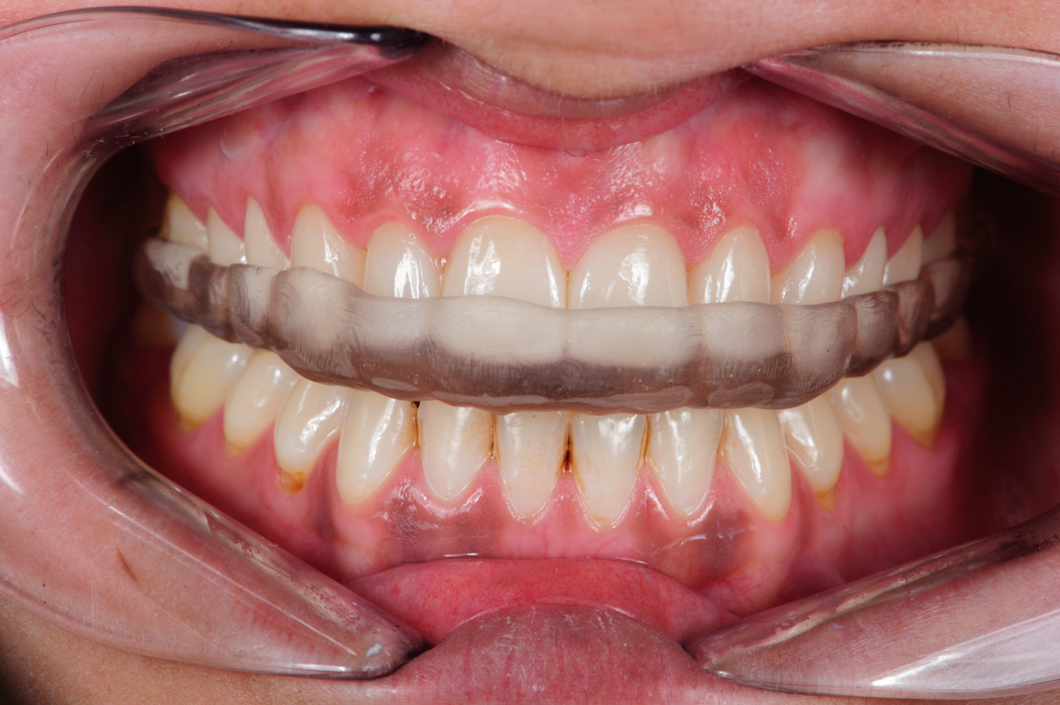 Bruxismo. Férula de descarga | Clínica Dental Blay Monzo